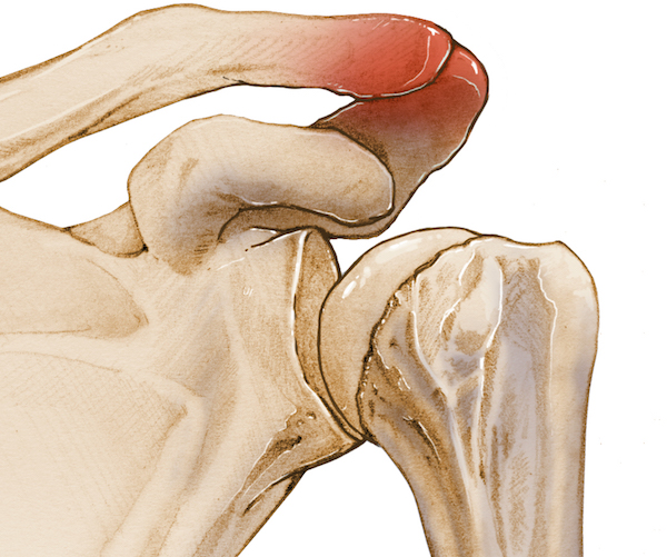 Acromioclavicular Arthritis